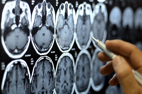 Hyperreactive Brain Network May Be Cause of Chronic Pain in ...
