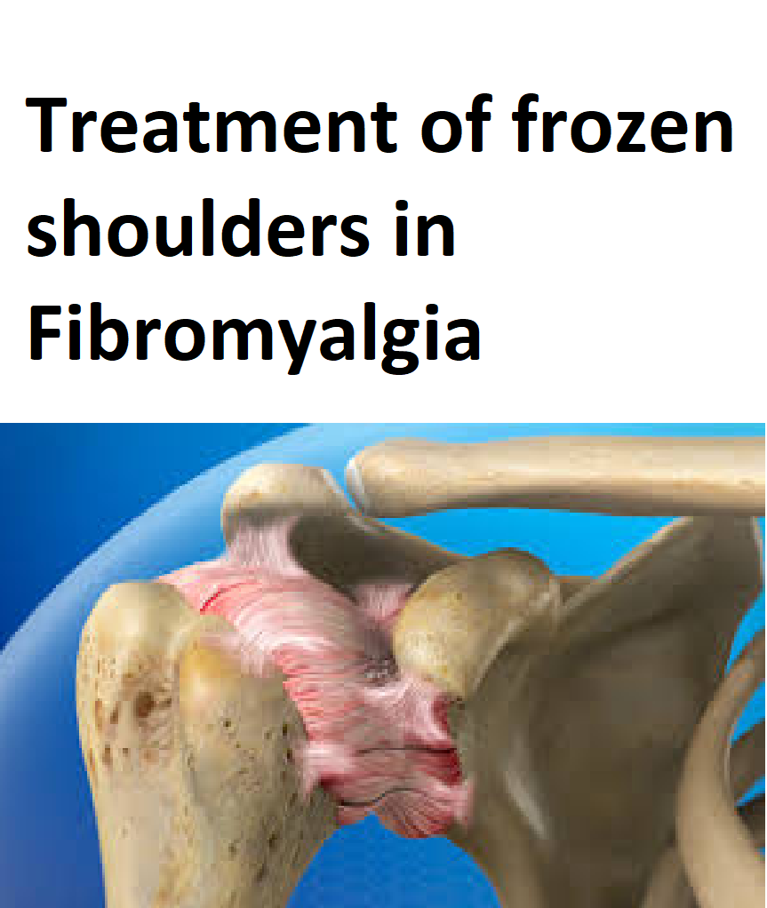 Treatment of frozen shoulders in Fibromyalgia - STAY AWARE WITH US