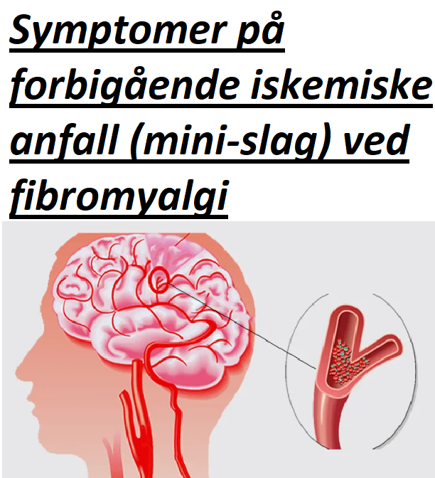 Symptomer på forbigående iskemiske anfall (mini-slag) ved fibromyalgi ...
