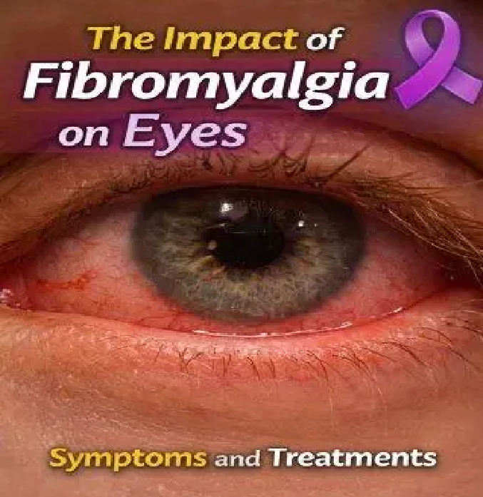 The Impact of Fibromyalgia on the Eyes: Symptoms, Sensations, and Paths ...